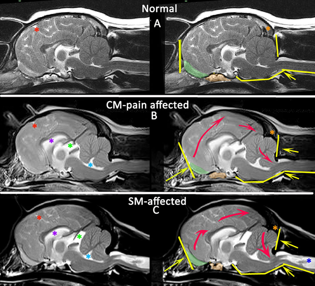 Syringomyelia and Chiari Malformation Injuries | Atlanta Injury Law Blog