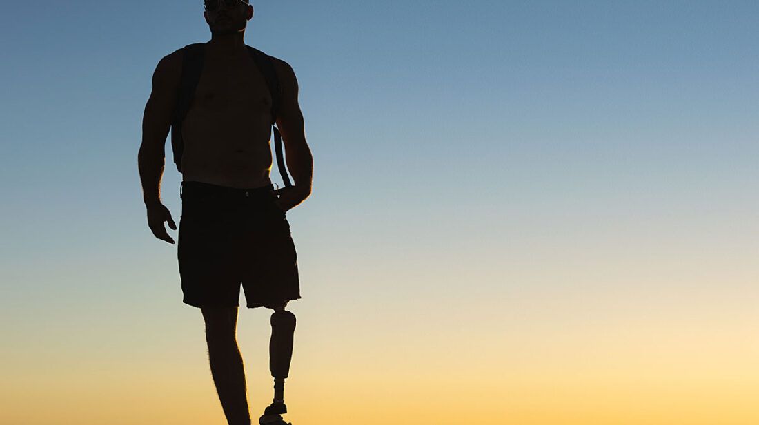 Leg Amputation Injuries | Atlanta Injury Law Blog